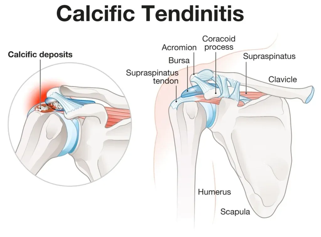 Calcific Tendinopathy: A Brief Overview